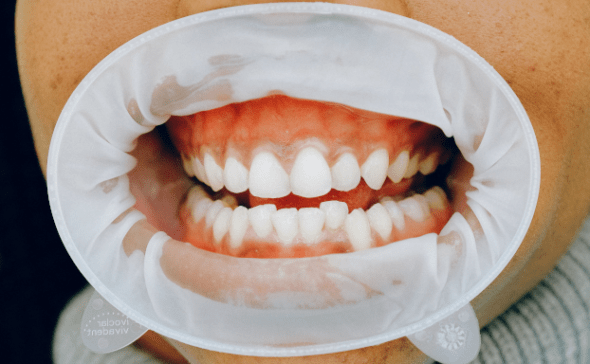 Types of Gingiva - Dental Pockets Blog