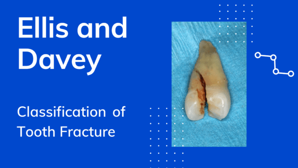 Ellis and Davey Classification (1970) - Dental Pockets Blog