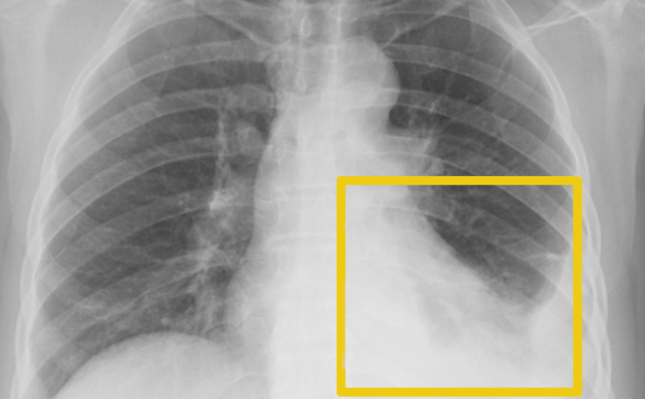 Clinical Features of Empyema - Dental Pockets Blog