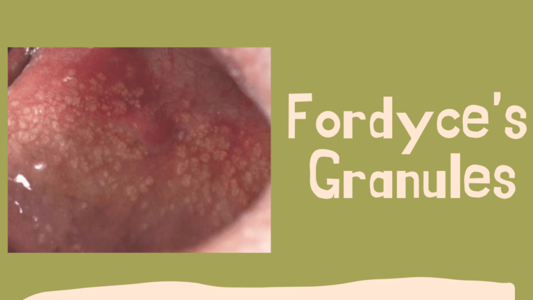 Fordyce's Granules - Dental Pockets Blog