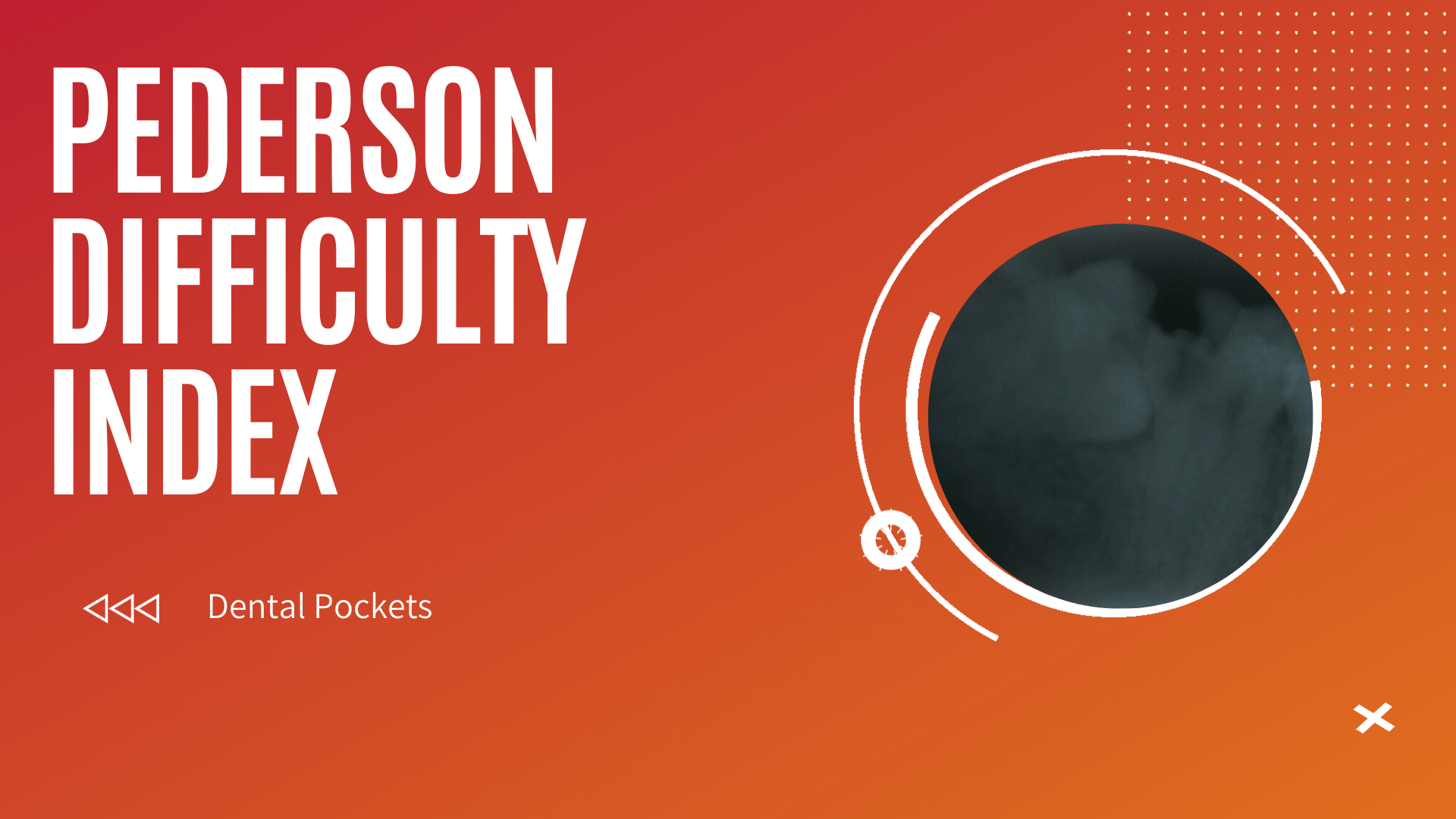 Pederson Difficulty Index - Dental Pockets Blog